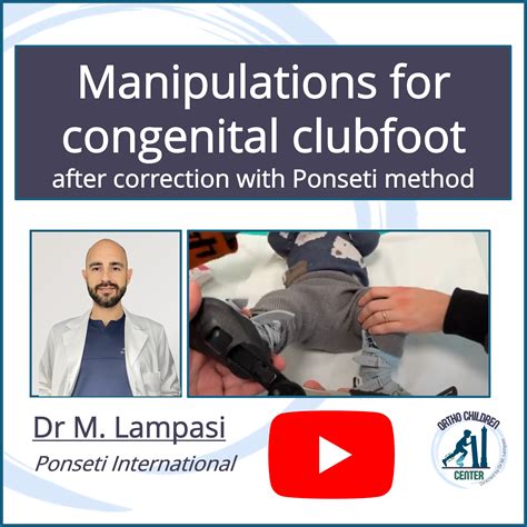 New Tutorial Manipulations For Clubfoot After Correction With The