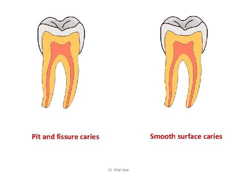 Histopathology Of Dental Caries Dr Maji Jose Smooth
