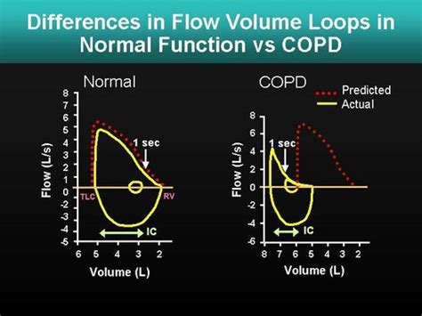 Mksap Pulm Ch Flashcards Quizlet