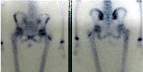 Both Views Of Technetium Scintigraphy Confirming The Absence Of Download Scientific Diagram
