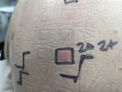 Patch Testing The Basics Robin Lewallan M D Board Certified Dermatologist Newport Beach