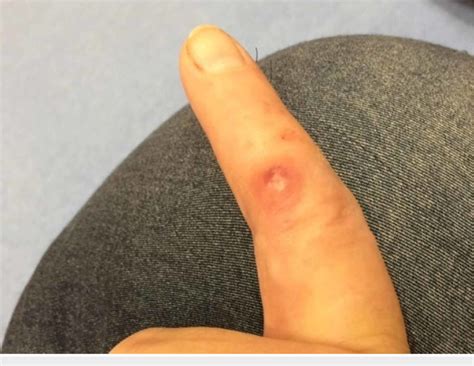 Nodule On The Index Finger Download Scientific Diagram