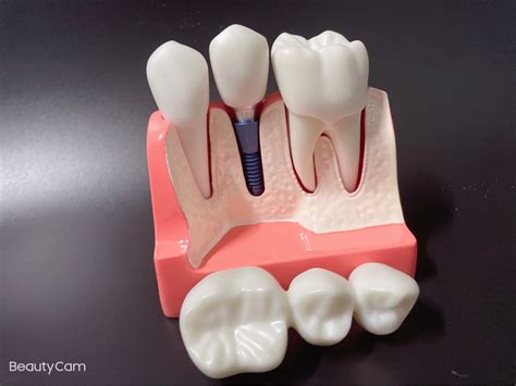 Dental Display Model Implant Model For Doctor Patient Communication Use Dental And Model