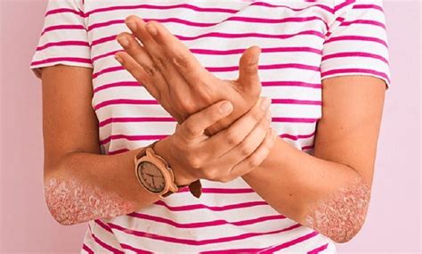 Artrite Psoriasica 7 Anni Per Una Diagnosi Test Online Aiuta A