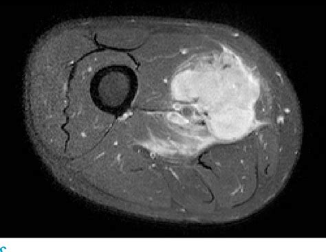 Figure 1 From Temporal Evolution Of A Chronic Expanding Organizing