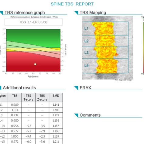 B Trabecular Bone Score Of The Same Patient Which Indicates Serious