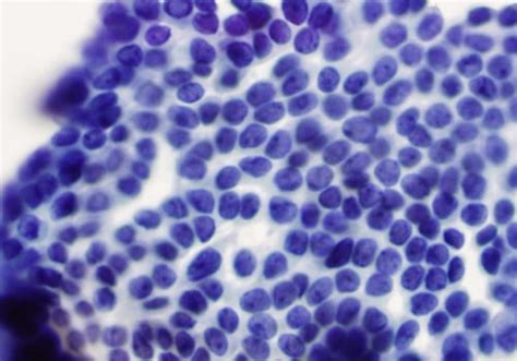 Treating Thyroid Cancer An Experts Guide