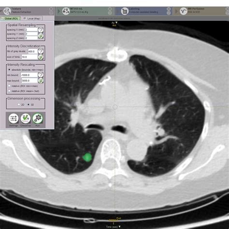 The Lesion Tissue Segmentation By Lifex Software Download Scientific