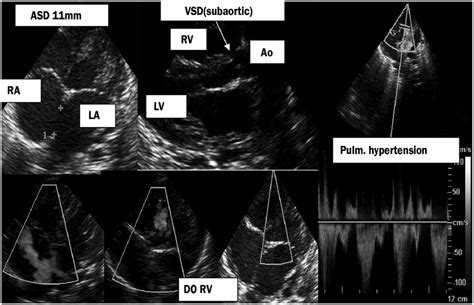 Double Outlet Right Ventricle Dorv Asdvsd Subaortic Pulmonary