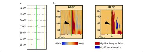 Detection Of Spike Related High Frequency Oscillations Hfos Using Download Scientific
