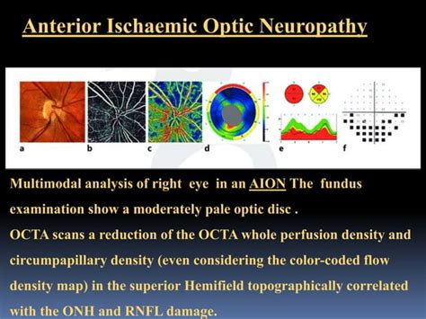 Prognostic Value Of Multiple Differential Diagnosis Of Onh By Oct Angio