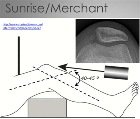 Knee Dx Imaging Flashcards Quizlet