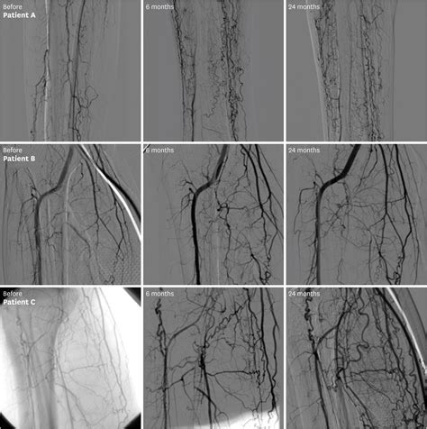 JCI Journal Of Cardiovascular Intervention