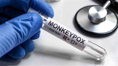 Monkeypox Detected In Asymptomatic Men MedPage Today