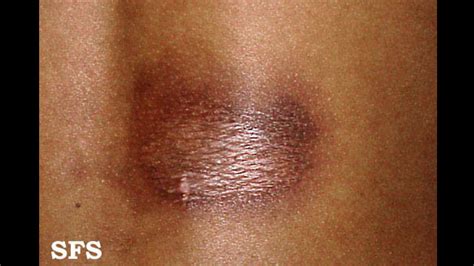Morphea Symptoms Causes And Treatments