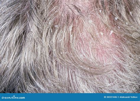 La Caspa Y Se Queda Calvo Foto De Archivo Imagen De Hombre 30331446