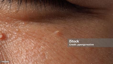 Verruga En La Cara Foto Macro De Verruga Cerca Del Ojo Papiloma En La