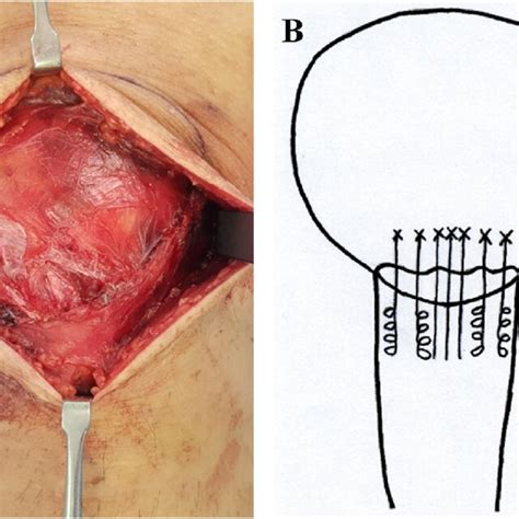 Intraoperative Photograph For Double Row Suture Anchor Fixation For Download Scientific Diagram