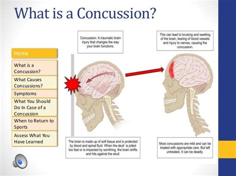 Aet 545 Concussion Tutorial By J Calhoun