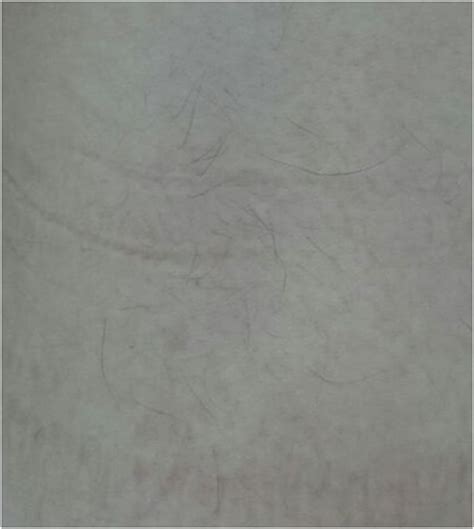 Moderate Hypertrichosis On The Patients Back Download Scientific Diagram