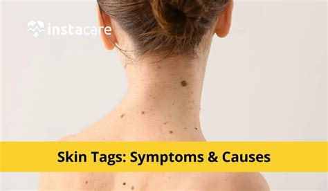 Skin Tags Skin Specialist Richmond Advanced Skincare And Facials