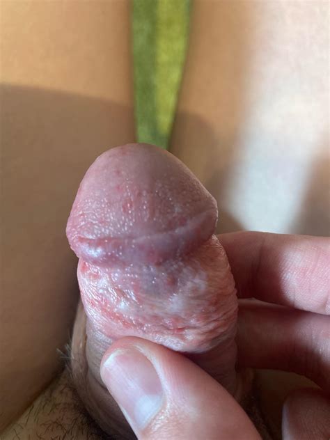 Red Spotsrash Penis And Foreskin Rdiagnoseme
