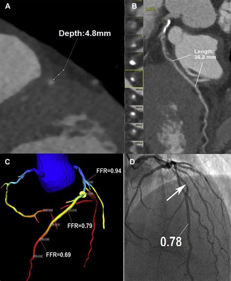 Coronary Computed Tomography Angiography Derived Fractional Flow