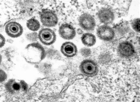 Chicken Pox Virus Under Microscope