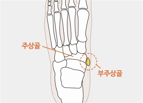 부주상골 증후군 원인 증상 및 치료방법 요약 깔창추천