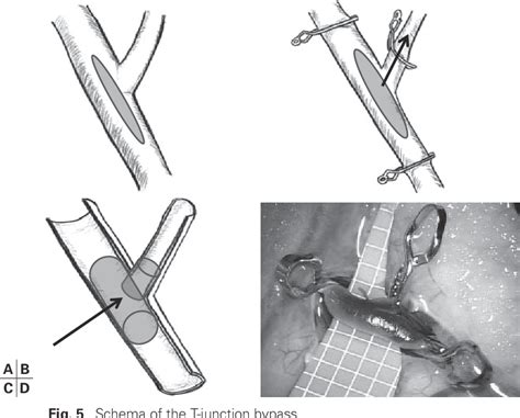 Figure 5 From Surgical Tips For Sta Mca Bypass From Misato Central General Hospital Semantic