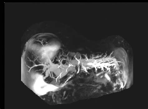 Magnetic Resonance Cholangiopancreatography Image Demonstrating A