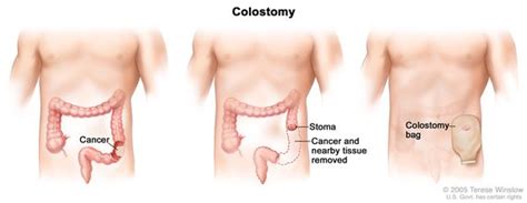 Definition Of Colostomy Nci Dictionary Of Cancer Terms Nci