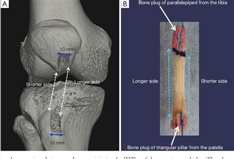 Figure 2 From Anatomical Rectangular Tunnel Acl Reconstruction With A
