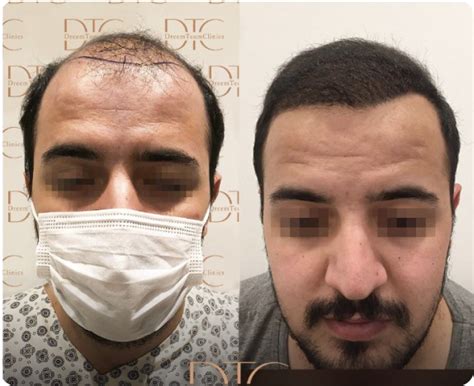 קצת עלינו Dtc Clinic השתלות שיער בטכנולוגיה מתקדמת