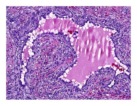 Bone And Soft Tissue Pathology Pptx