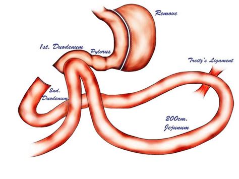 Loop Duodenojejunal Bypass With Sleeve Gastrectomy Dramit Garg