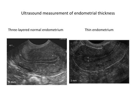 Normal Endo Thickness Of Uterus At Sandra Karcher Blog