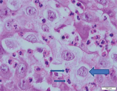 Significant Neutrophilic Emperipolesis In Squamous Cell Carcinoma