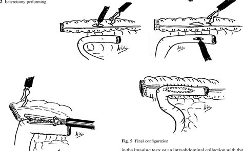 What Checks Ileocolic Anastomosis Procedure