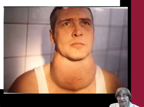 Understanding Surgical Diseases Of The Thyroid Gland Galaxy Ai