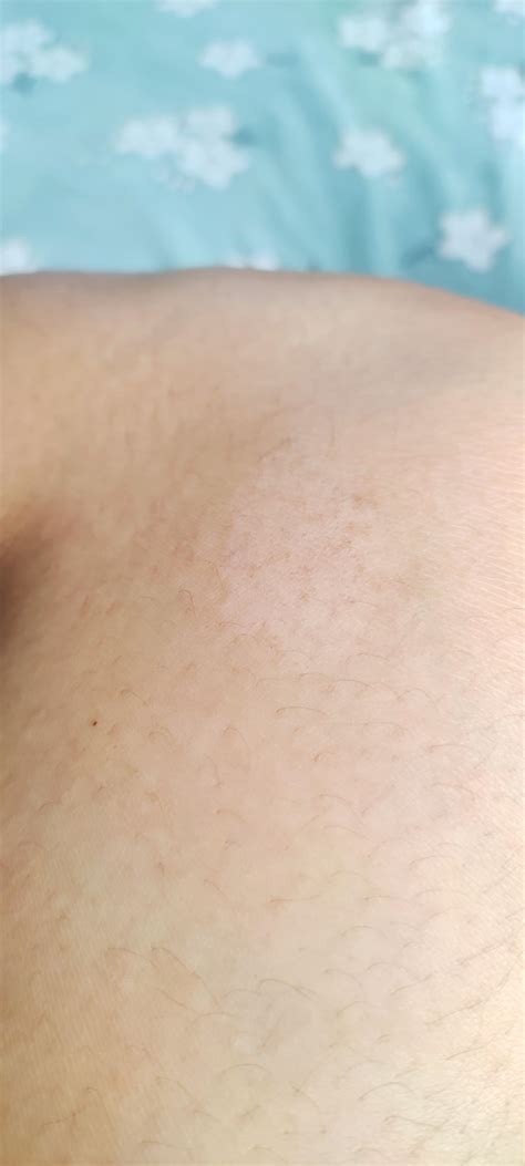Why Do I Have A Birthmark On My Chest At Annabelle Raggatt Blog