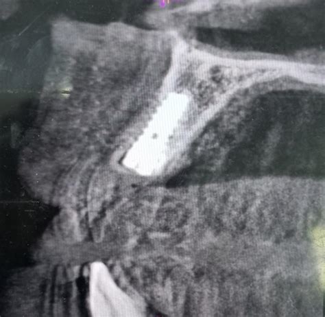 Buccal Defect Addressed With Indian Allograft And Soft Tissue Matrix