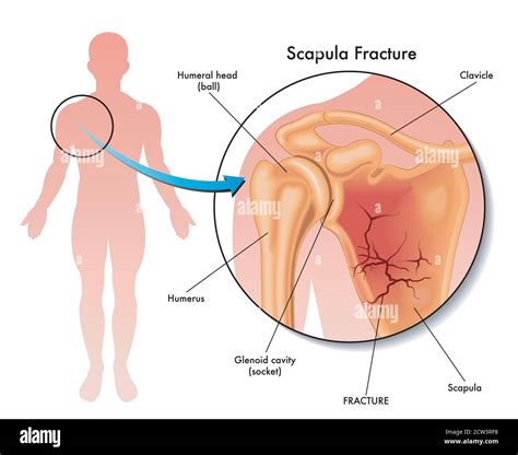 Scapula Diagram Glenoid Fossa
