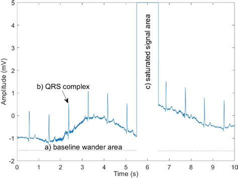Figure 1 From Removal Of Motion Artifacts In Capacitive Electrocardiogram Acquisition A Review