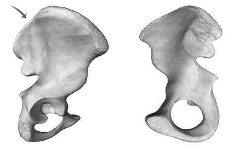 Medial And Lateral Views Of The Hip Bone Ilium Ischium Pubis