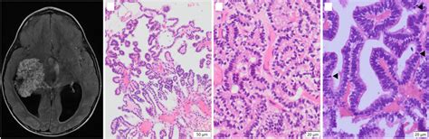 Choroid Plexus Atypical Papilloma Images A Magnetic Resonance Download Scientific Diagram