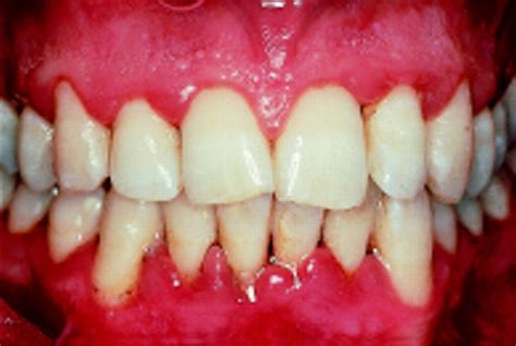 Periodontal Disease The Bmj