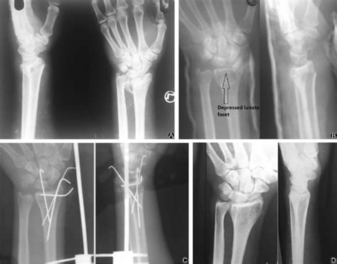 Die Punch Fracture