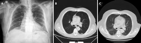 A Chest Radiography Revealed Bilateral Opacities Consistent With Focal