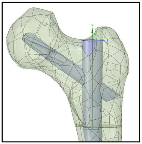 Computational Simulation Of A Femoral Nail Fracture
